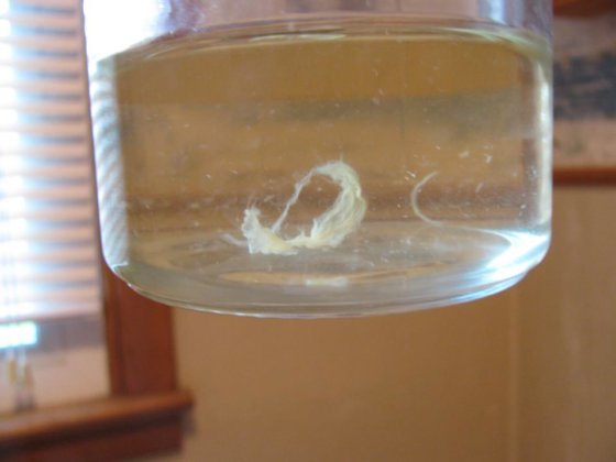 Mucus threads in urine-What is it, 8 Causes, Symptoms, 7 Treatments