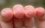 Callus on finger-Causes, Home remedies to get rid of them, Prevention