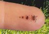 Symptoms of seed ticks bite and How to get rid of seed ticks at home