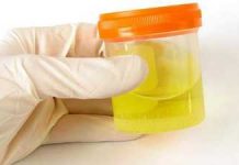 White tissue in urine-9 Must know Causes