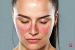 Red patches on face: 9 Causes, 7 Home Remedies